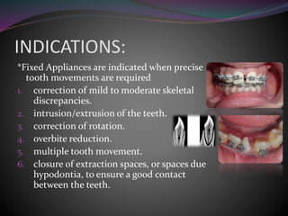 Fixed orthodontic appliances by khaled sadeq | PPTX