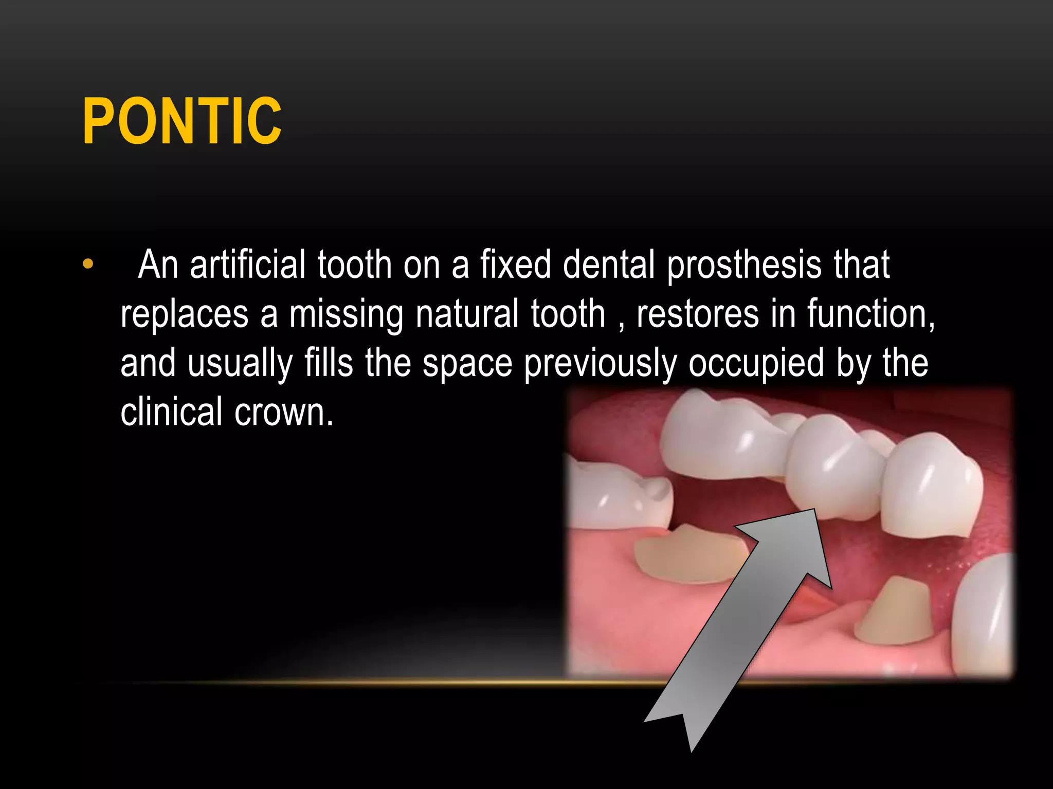 Fixed prosthodontic | PPSX