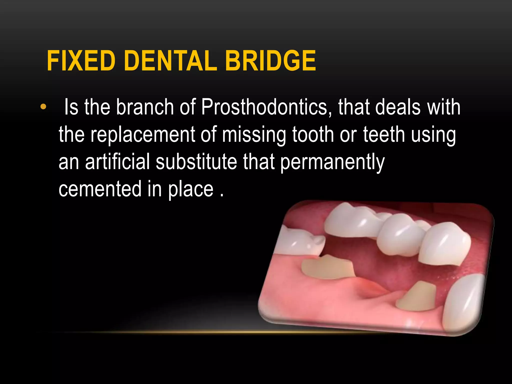 Fixed prosthodontic | PPSX