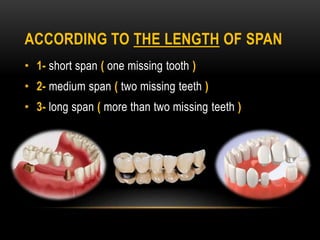 Fixed prosthodontic | PPSX