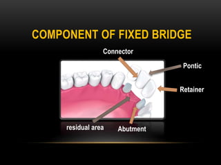 Fixed prosthodontic | PPSX