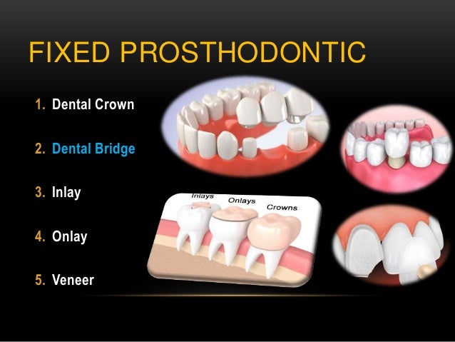 Fixed prosthodontic