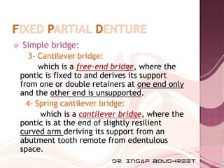 Spring Cantilever Bridge Dental