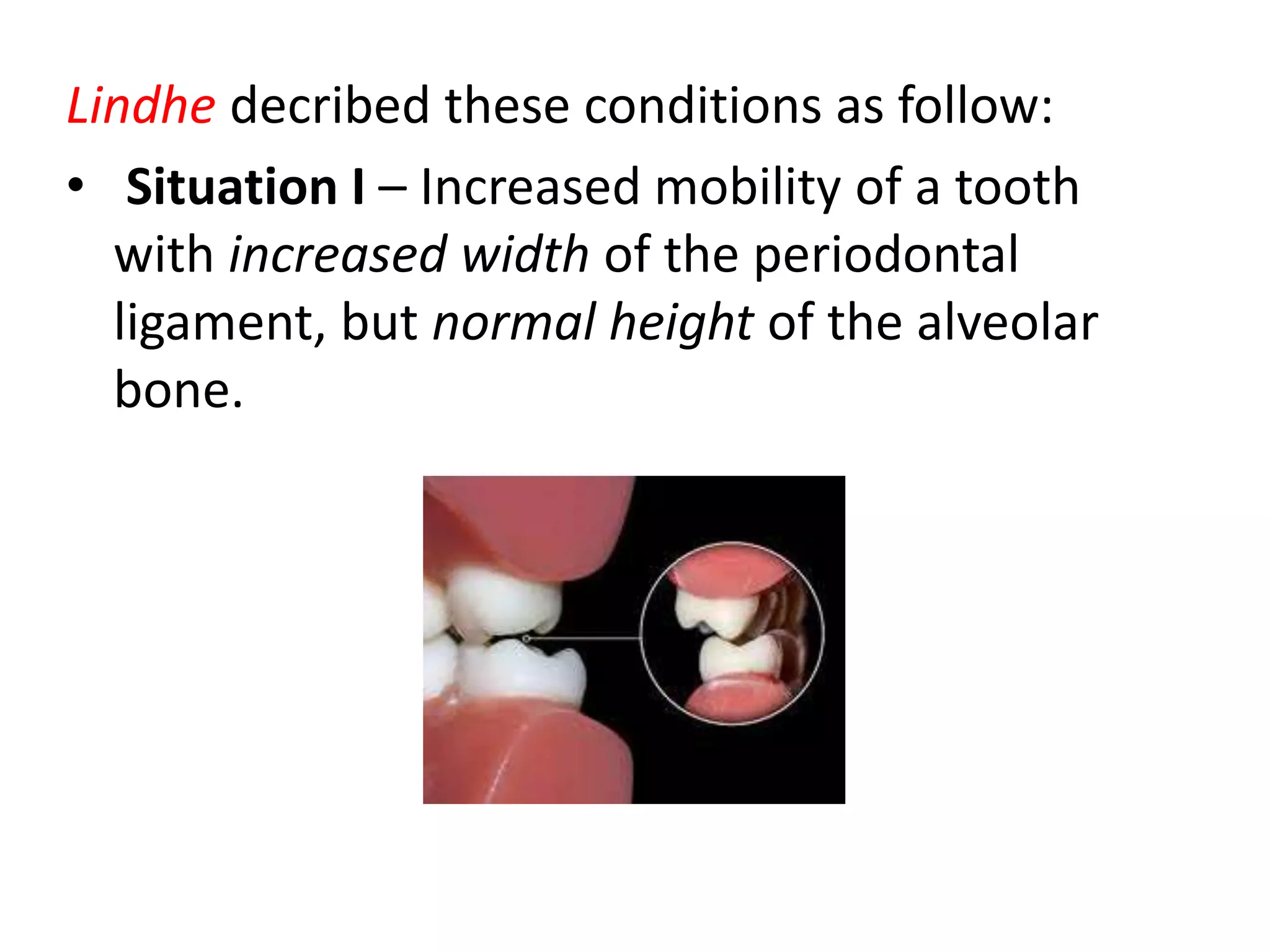 Fixed prosthodontics with periodontally compromised dentition | PPTX