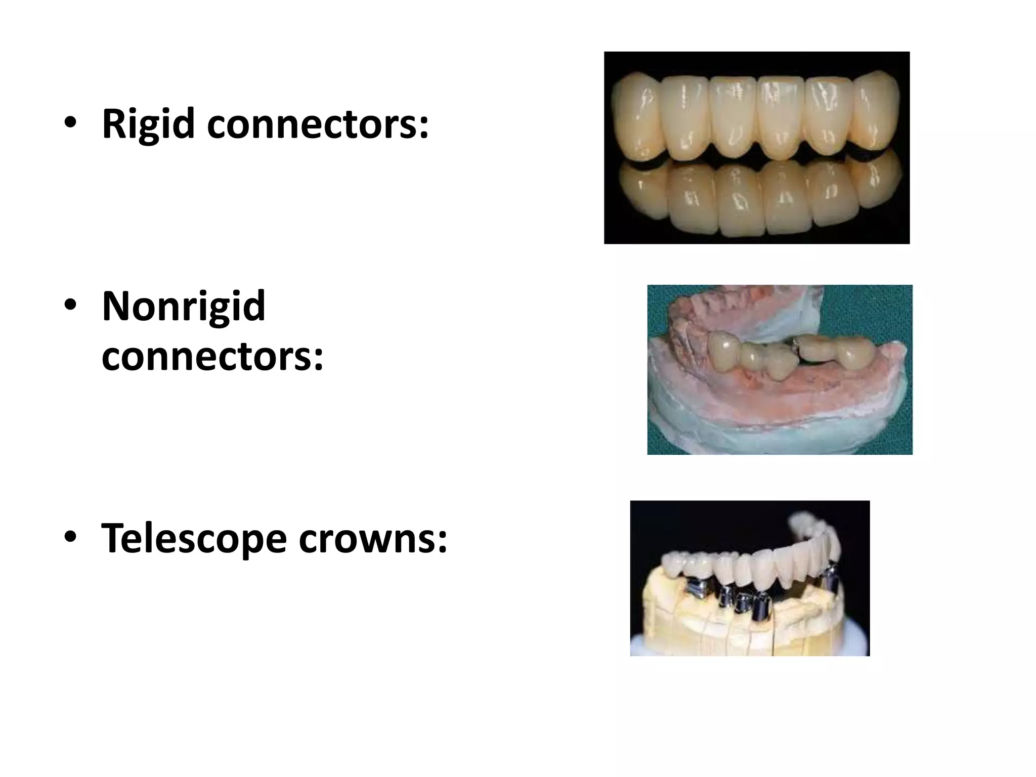 Fixed prosthodontics with periodontally compromised dentition | PPTX