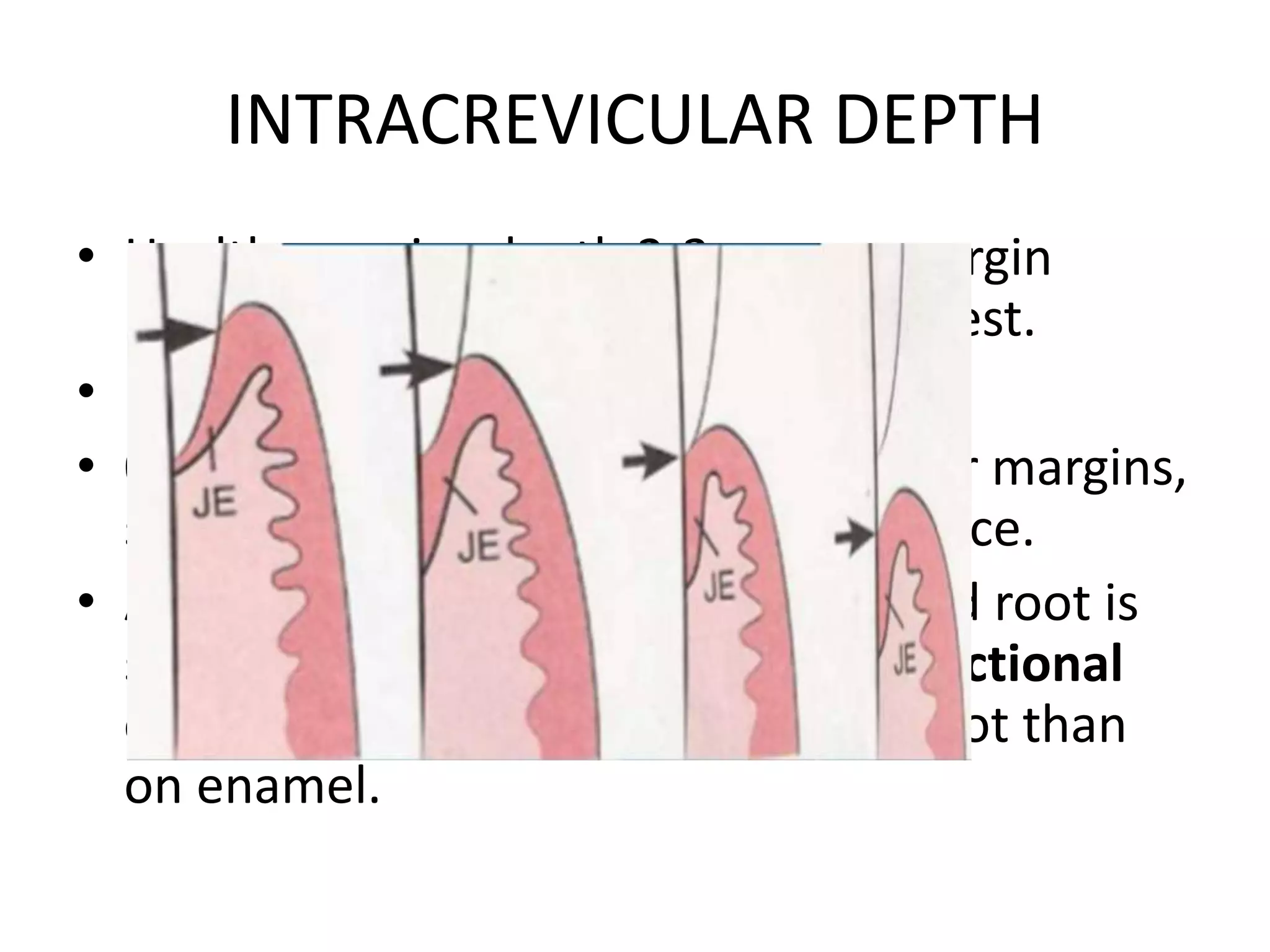 Fixed prosthodontics with periodontally compromised dentition | PPTX