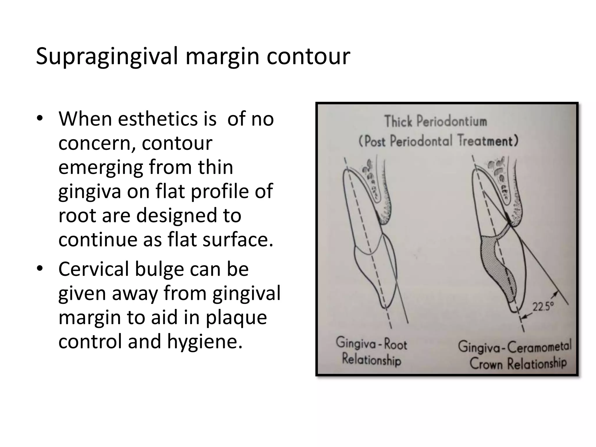 Fixed prosthodontics with periodontally compromised dentition | PPTX