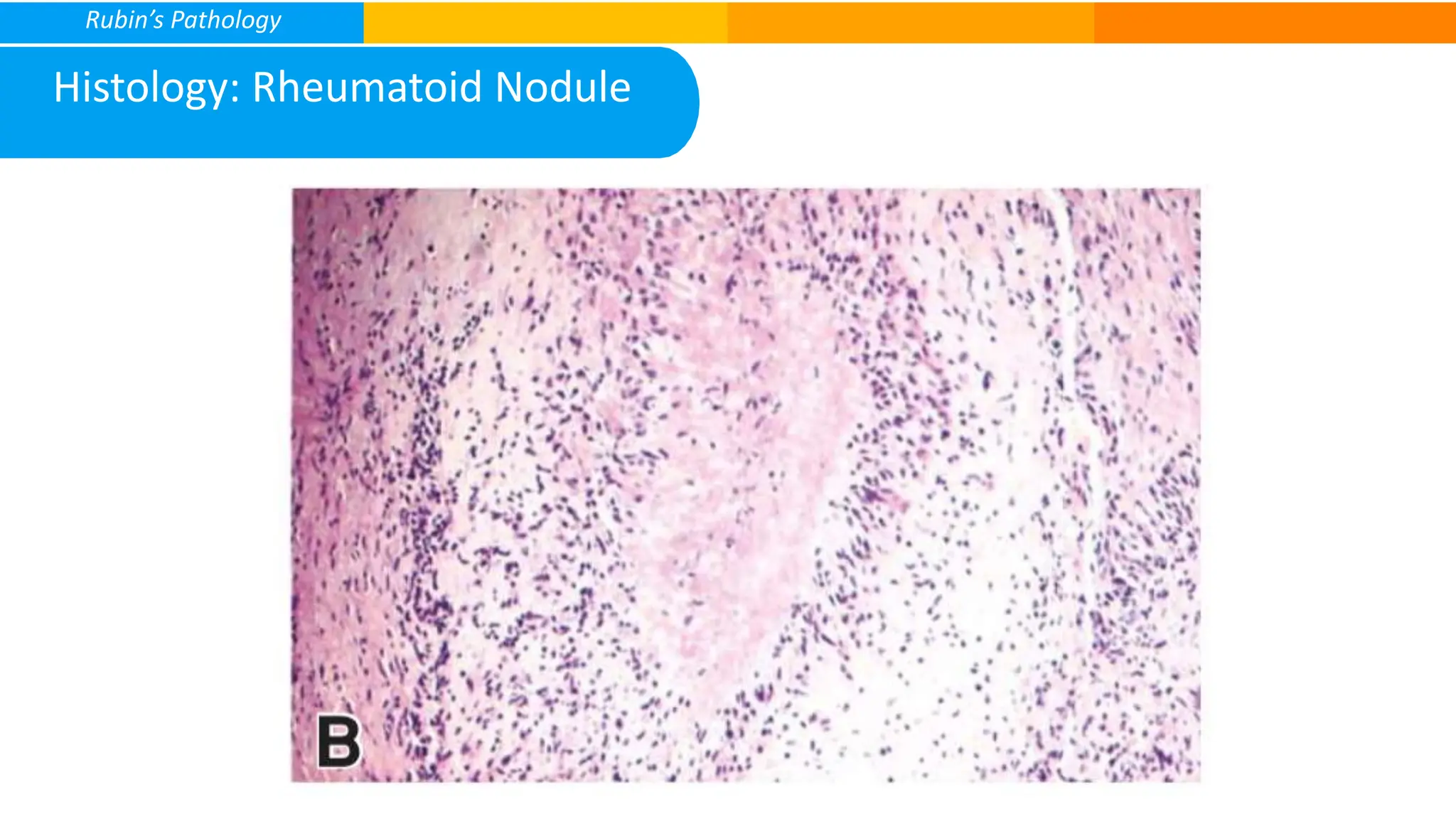 Histopathology of Rheumatoid Arthritis: Visual treat | PPTX