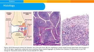 Histopathology of Rheumatoid Arthritis: Visual treat | PPTX
