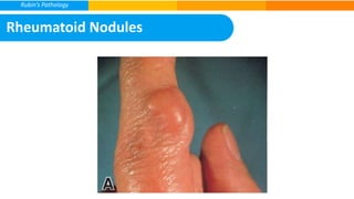 Histopathology of Rheumatoid Arthritis: Visual treat | PPT