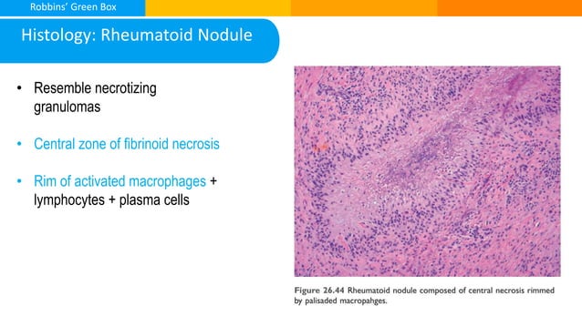 Histopathology of Rheumatoid Arthritis: Visual treat | PPT