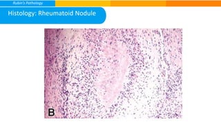 Histopathology of Rheumatoid Arthritis: Visual treat | PPTX