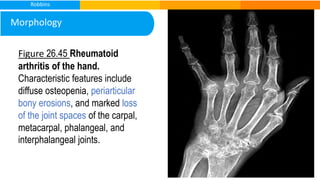 Histopathology of Rheumatoid Arthritis: Visual treat | PPTX