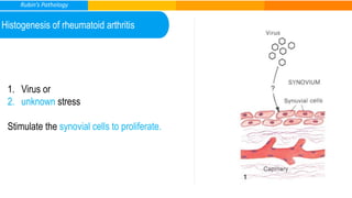 Histopathology of Rheumatoid Arthritis: Visual treat | PPTX