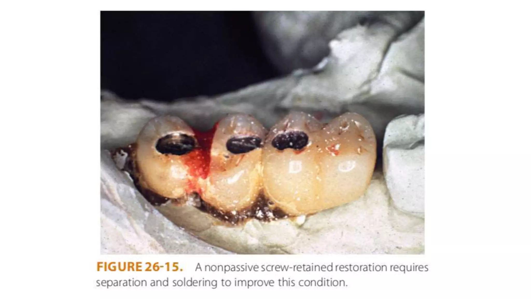 Principles of Fixed Implant prosthetics | PPTX