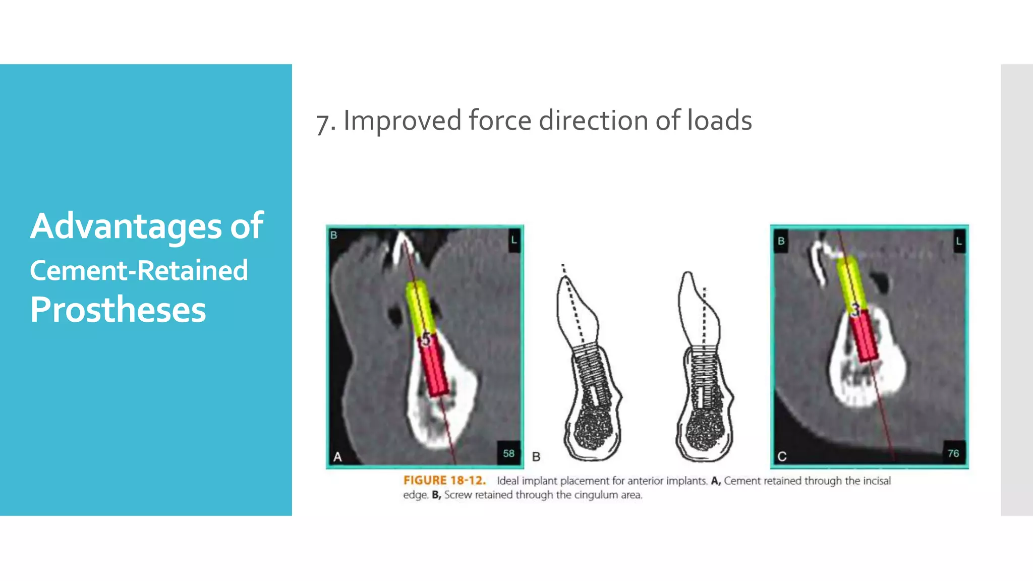 Principles of Fixed Implant prosthetics | PPTX