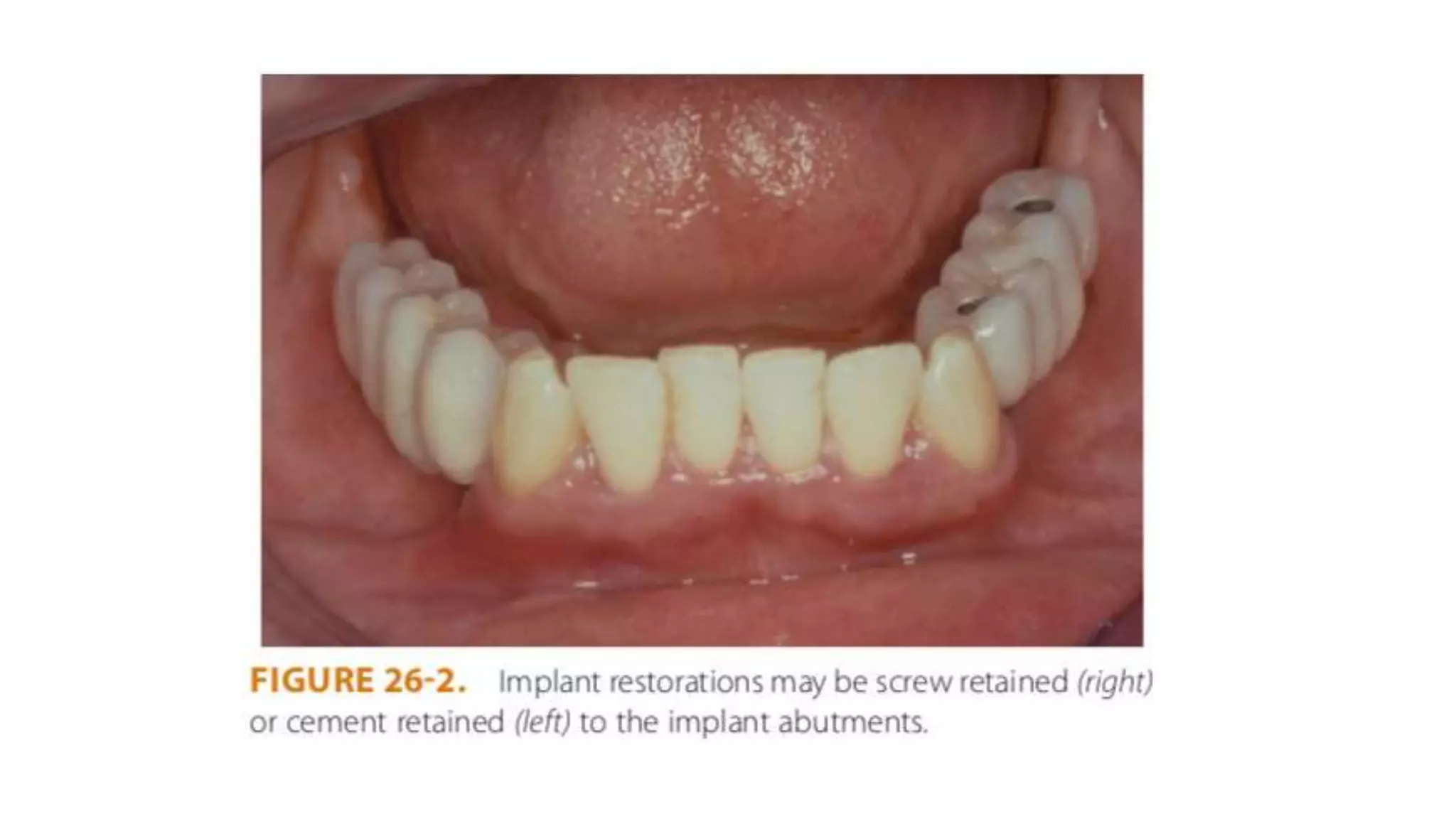 Principles of Fixed Implant prosthetics | PPTX