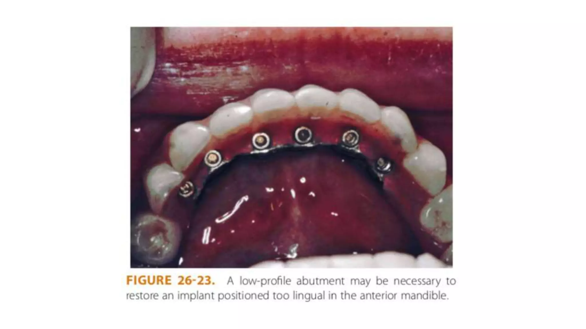 Principles of Fixed Implant prosthetics | PPTX