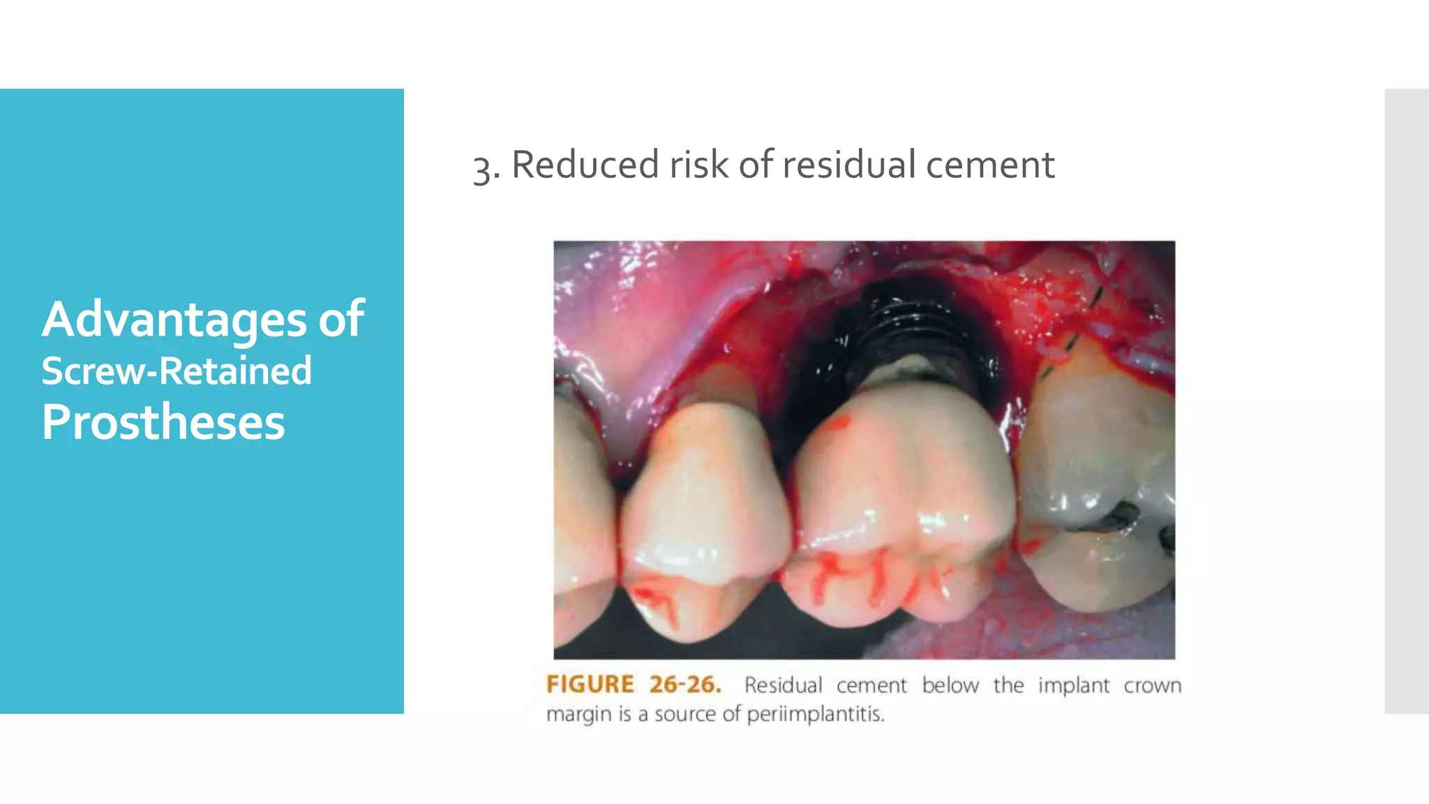 Principles of Fixed Implant prosthetics | PPTX