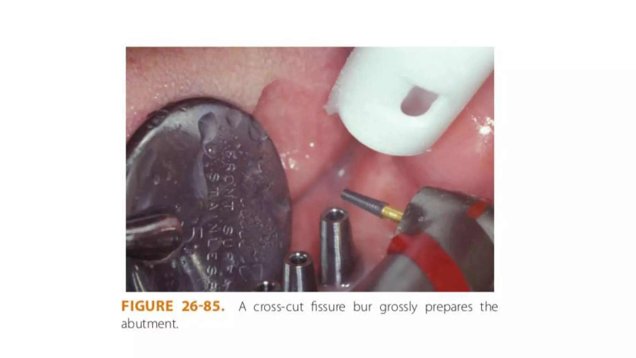 Principles of Fixed Implant prosthetics | PPTX