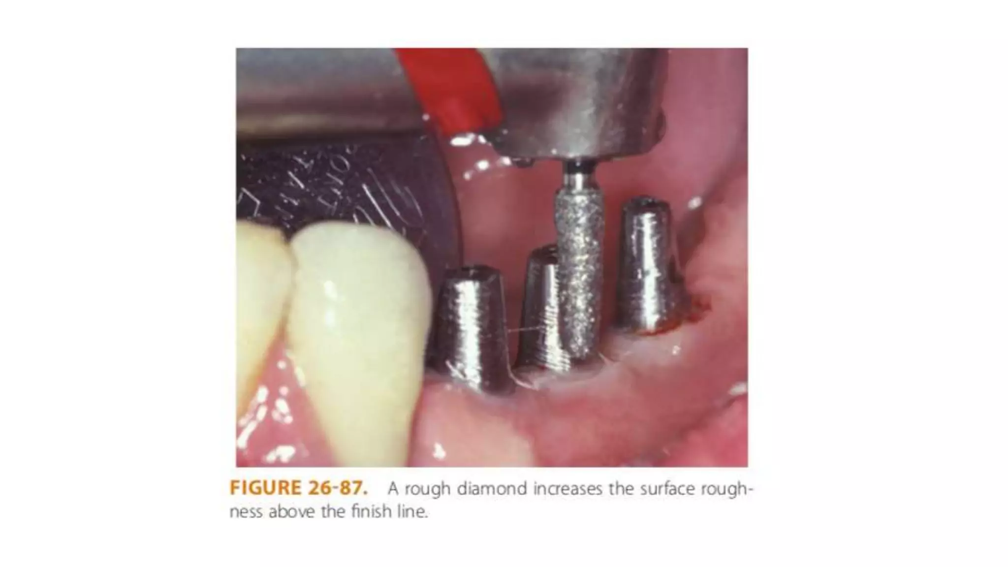 Principles of Fixed Implant prosthetics | PPTX