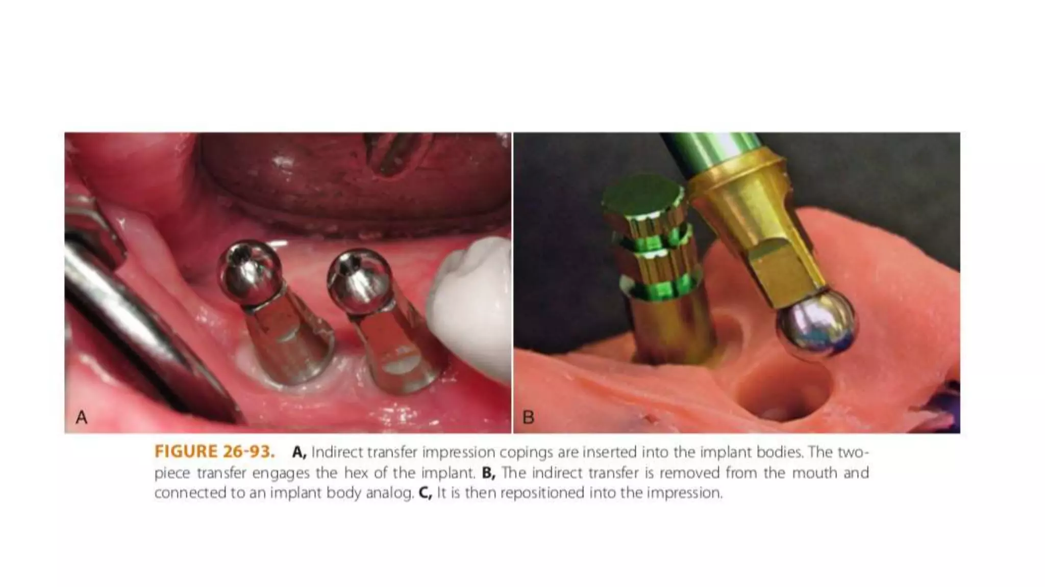 Principles of Fixed Implant prosthetics | PPTX
