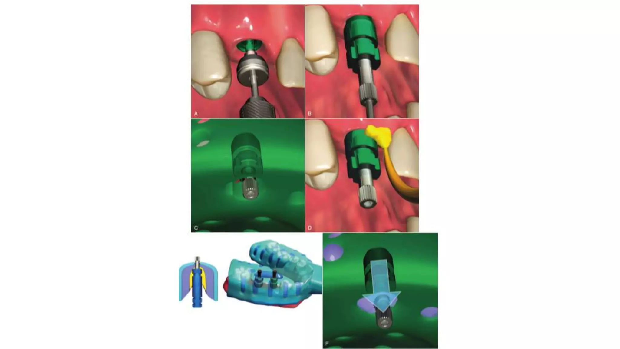 Principles of Fixed Implant prosthetics | PPTX