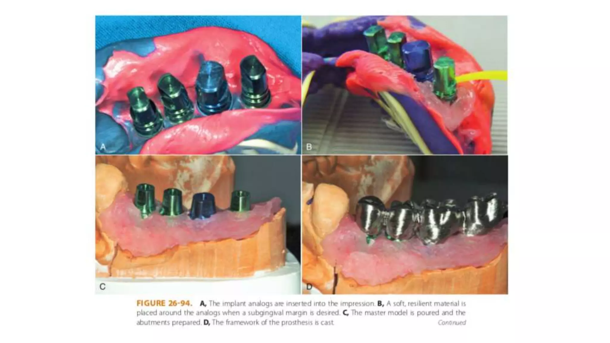 Principles of Fixed Implant prosthetics | PPTX