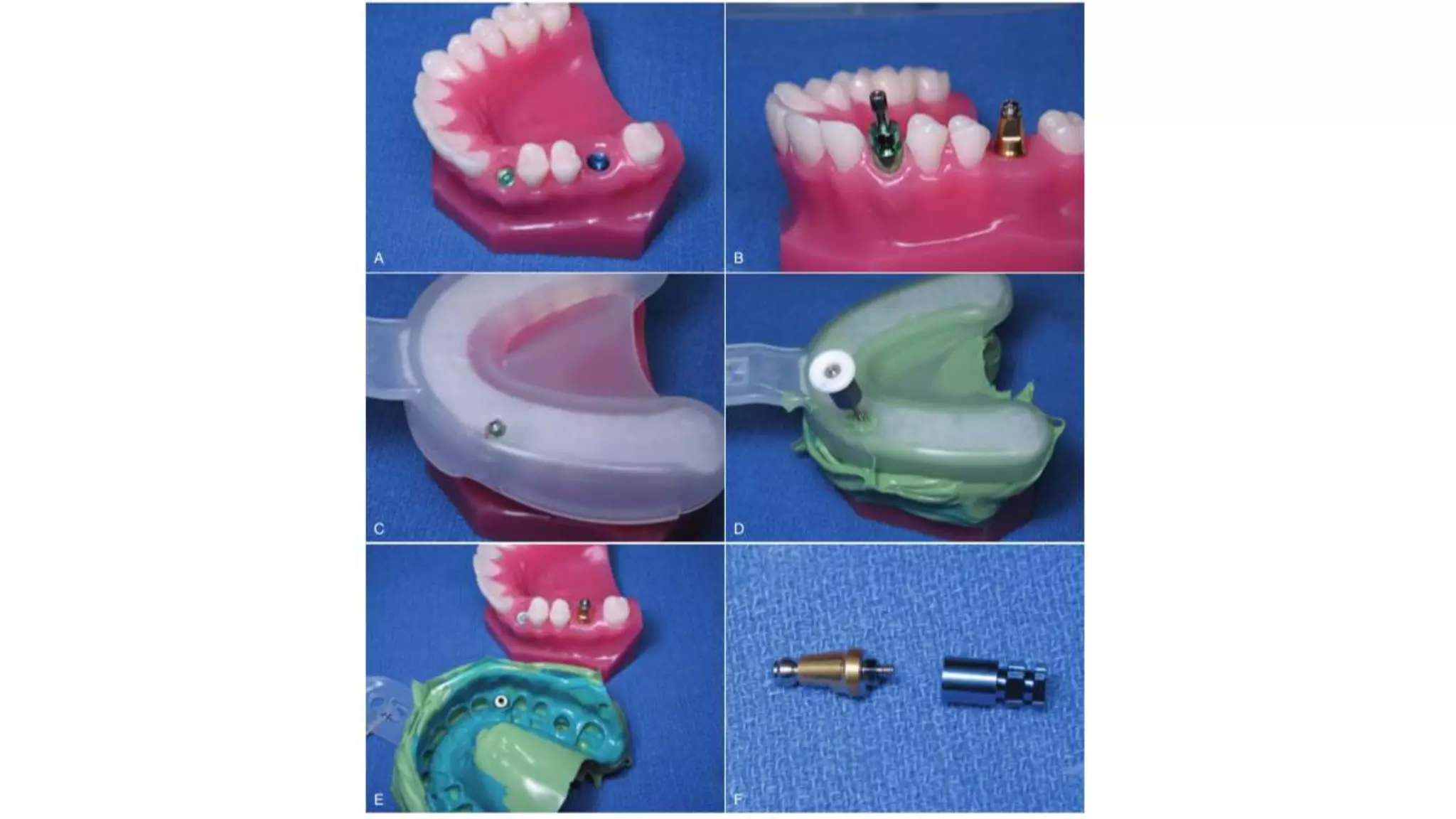 Principles of Fixed Implant prosthetics | PPTX