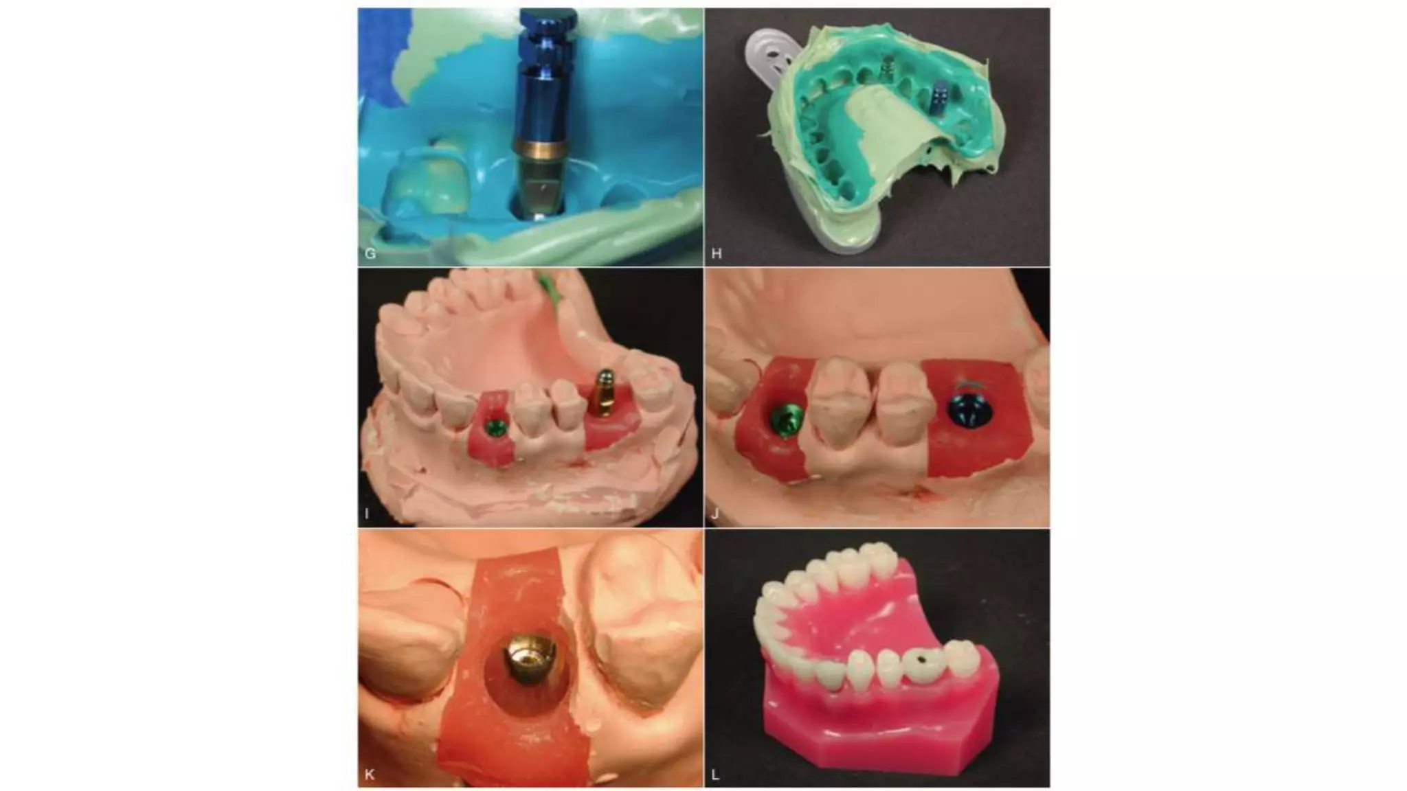 Principles of Fixed Implant prosthetics | PPTX