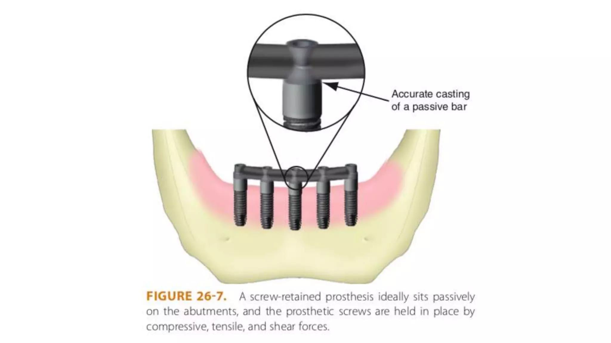 Principles of Fixed Implant prosthetics | PPTX