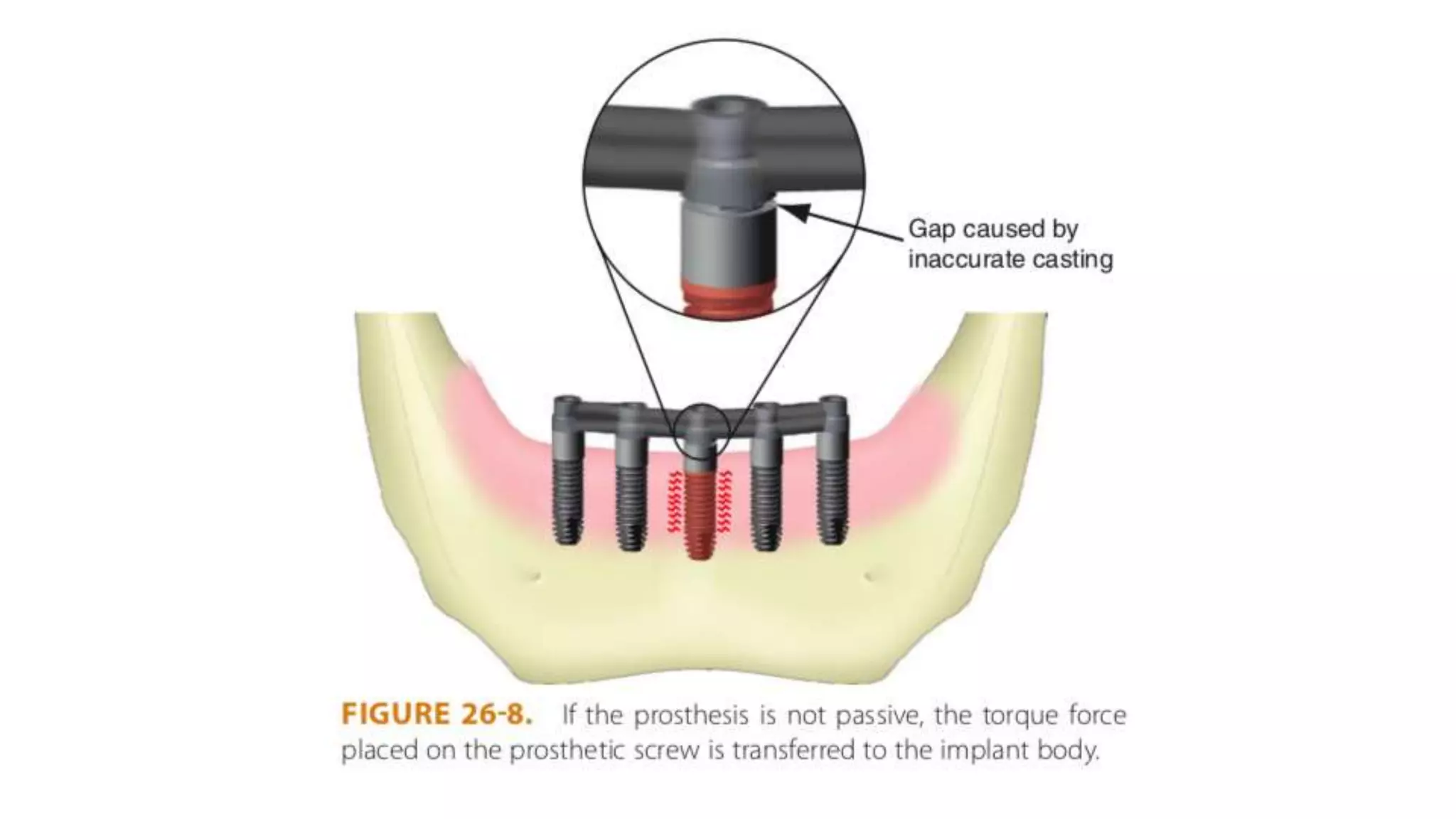 Principles of Fixed Implant prosthetics | PPTX