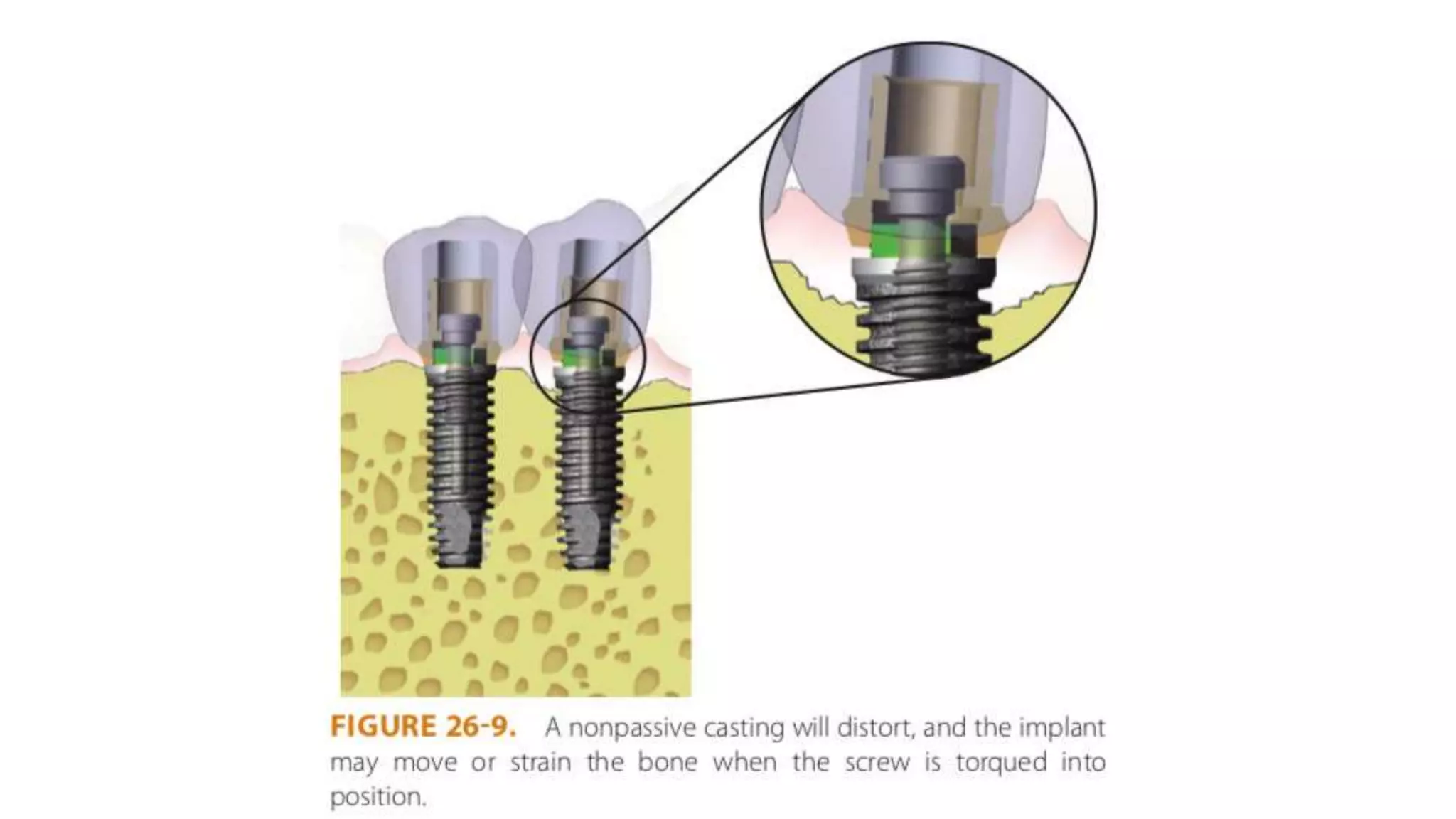 Principles of Fixed Implant prosthetics | PPTX