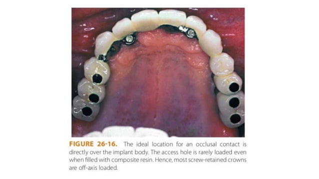 Principles of Fixed Implant prosthetics | PPTX