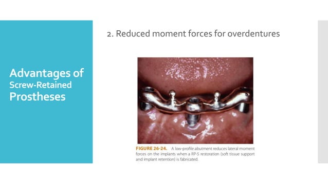 Principles of Fixed Implant prosthetics | PPTX