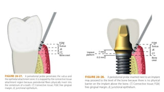 Principles of Fixed Implant prosthetics | PPTX