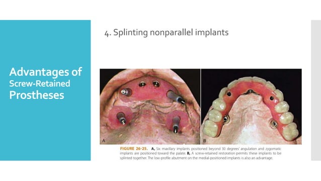 Principles of Fixed Implant prosthetics | PPTX