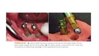 Principles of Fixed Implant prosthetics | PPTX