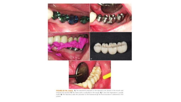 Principles of Fixed Implant prosthetics | PPTX