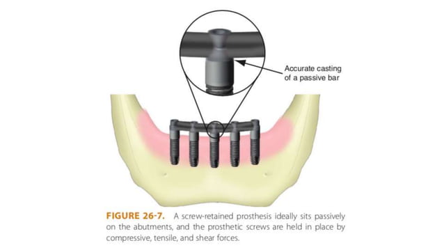 Principles of Fixed Implant prosthetics | PPTX