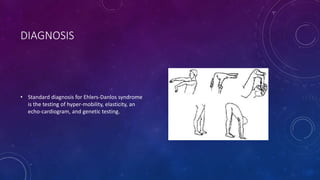 Ehlers-Danlos syndrome | PPTX