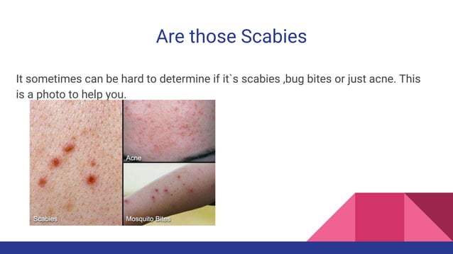 Scabies | PPTX