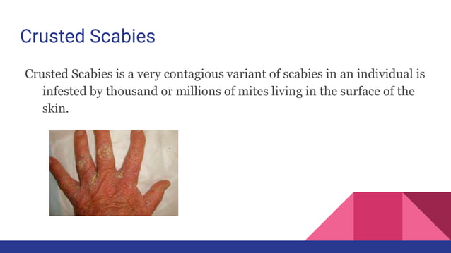 Scabies | PPTX