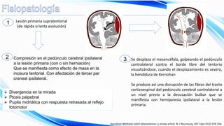 Kernoham-Woltman Se define como un déficit motor de origen central, que ...