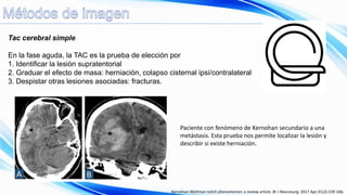 Kernoham-Woltman Se define como un déficit motor de origen central, que ...