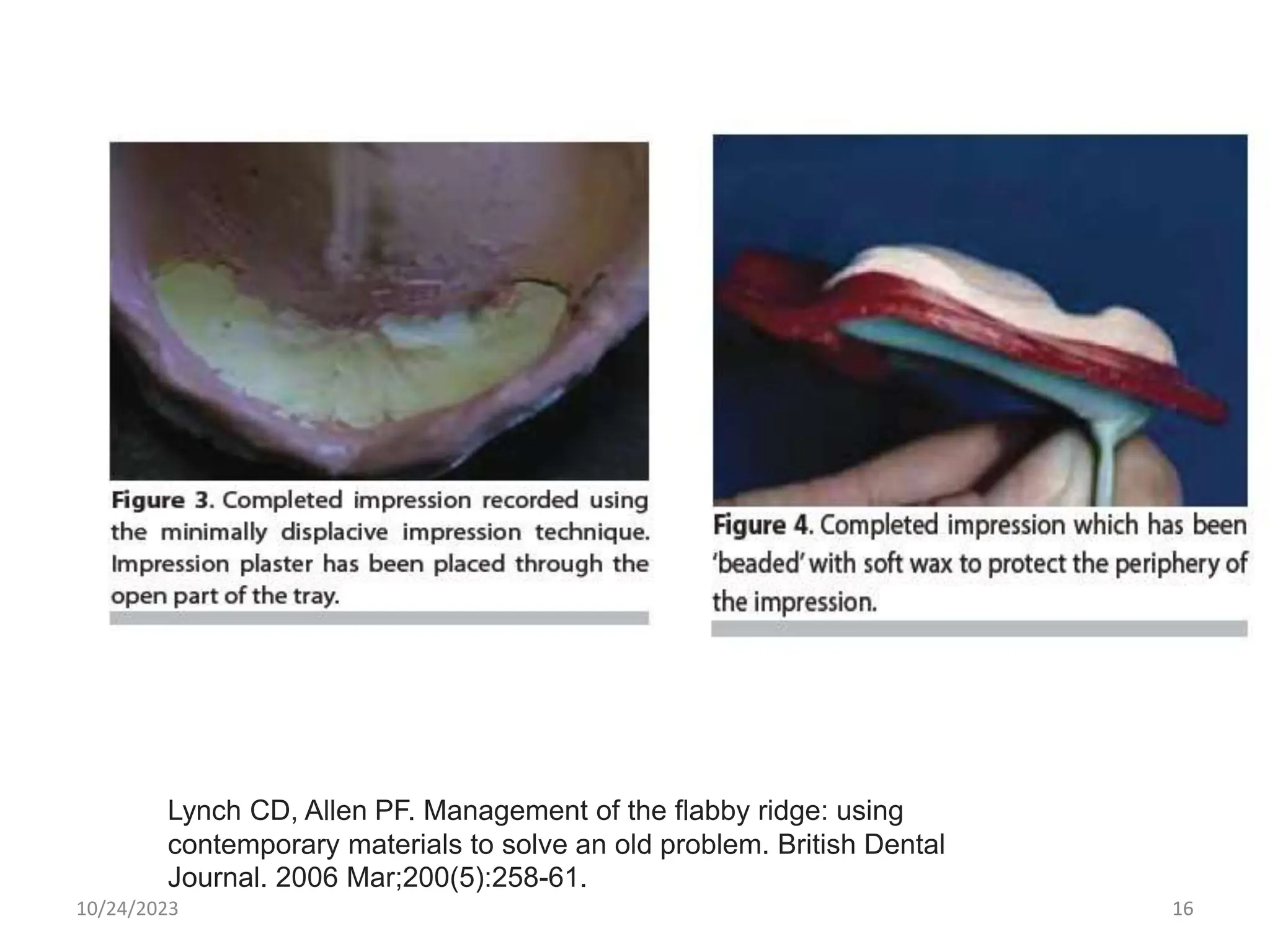 Journal club on Management of flabby ridges | PPTX