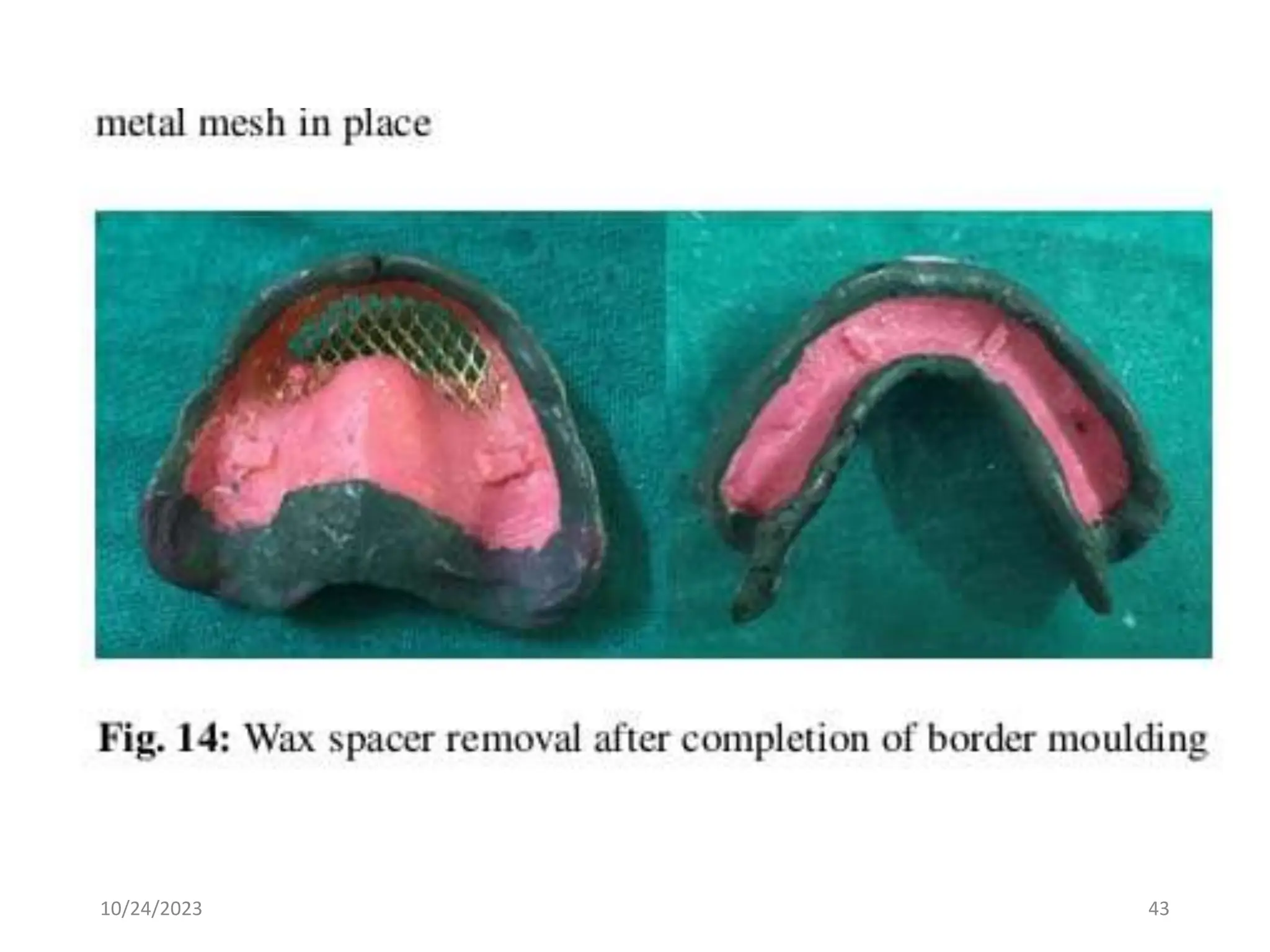 Journal club on Management of flabby ridges | PPTX