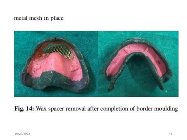 Journal club on Management of flabby ridges | PPTX | Oral care ...