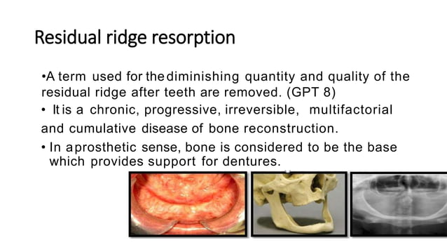 MANAGEMENT OF SEVERELY RESORBED RIDGES | PPTX