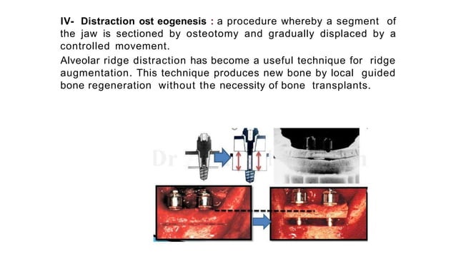 MANAGEMENT OF SEVERELY RESORBED RIDGES | PPTX